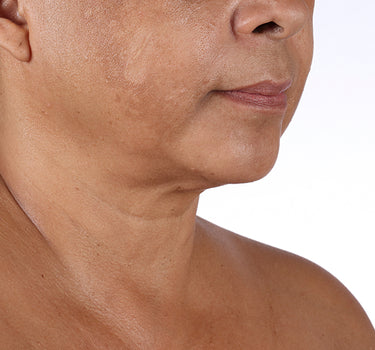 NuFACE Real Results: Before & After